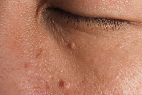 Skin Tags: Understanding These Common Skin Growths - Coast Dermatology ...