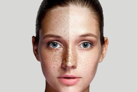 Melasma: The Mask You Can't Take Off - Coast Dermatology & Skin Cancer ...